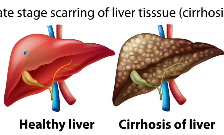 ¿Cuáles son los síntomas y causas de la cirrosis? Cómo tratarla