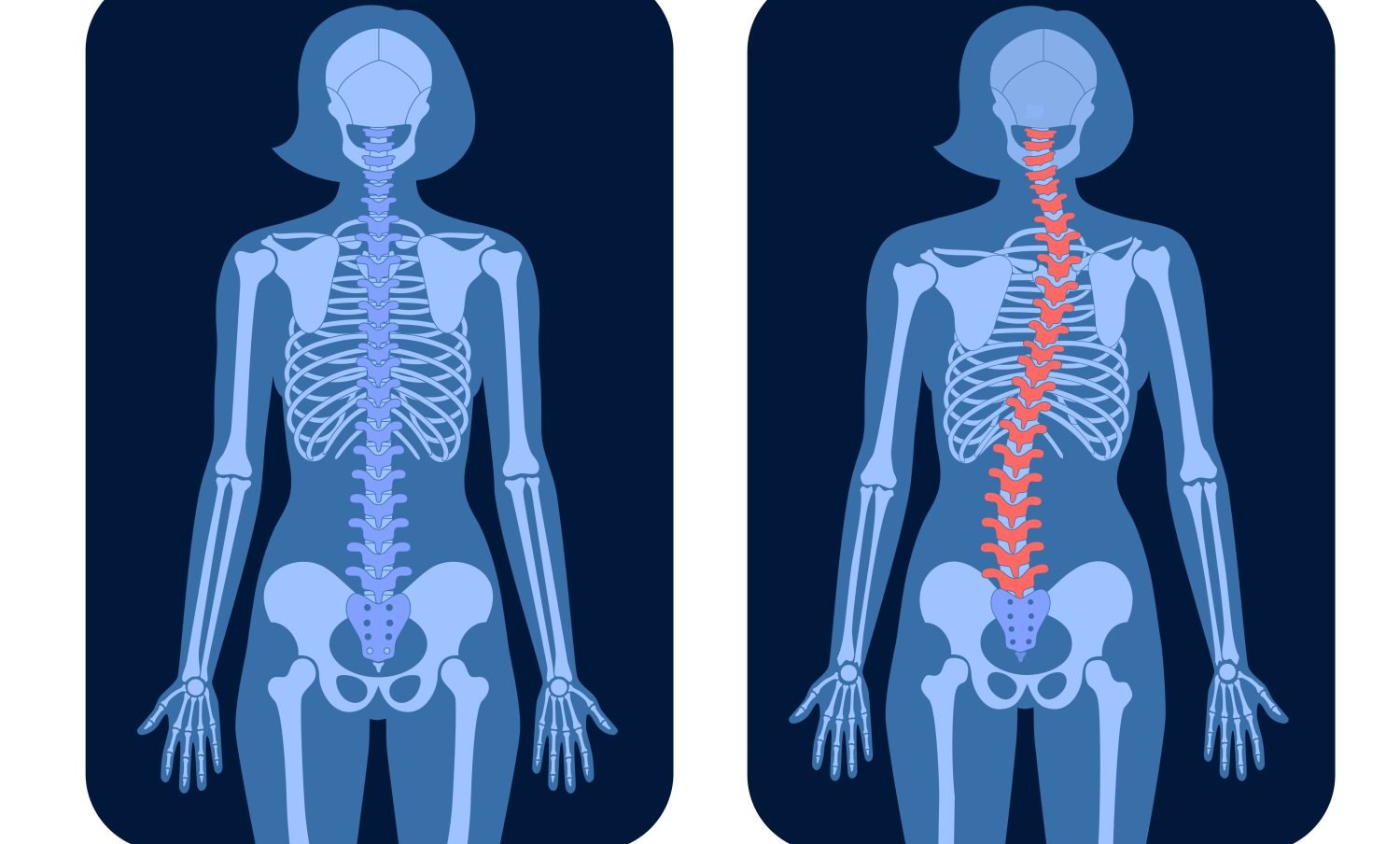 Qué es la escoliosis: señales para reconocerla y cómo tratarla